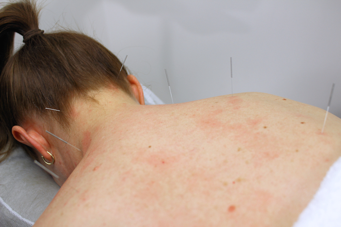 How to Identify and Heal Shoulder Bursitis - Evolution Medical Care