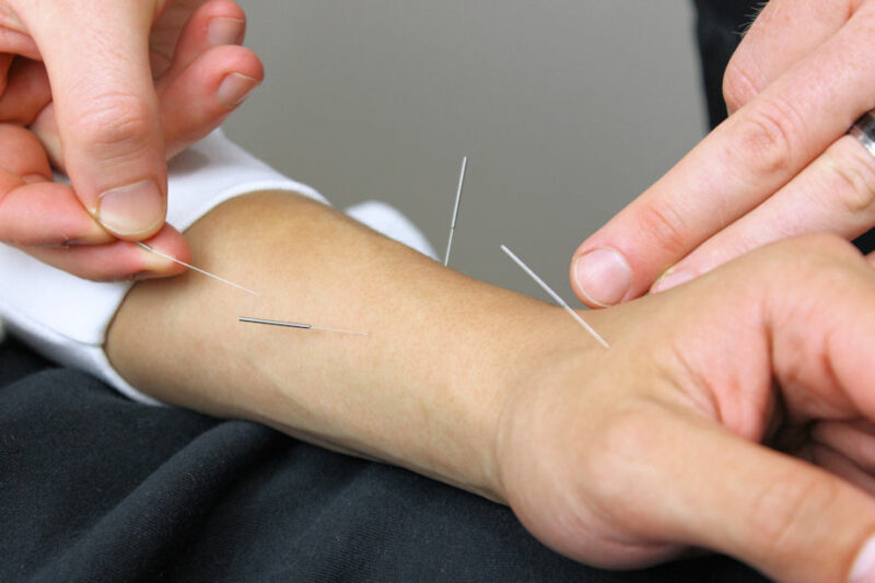 Does Acupuncture Hurt? Debunking Myths